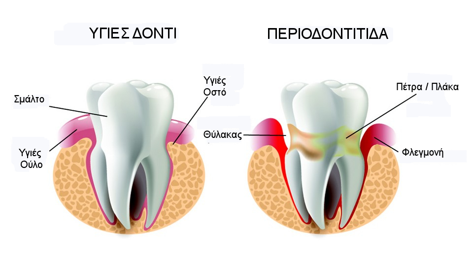 Θεραπεία Περιοδοντίτιδας | Zikoulis Dental